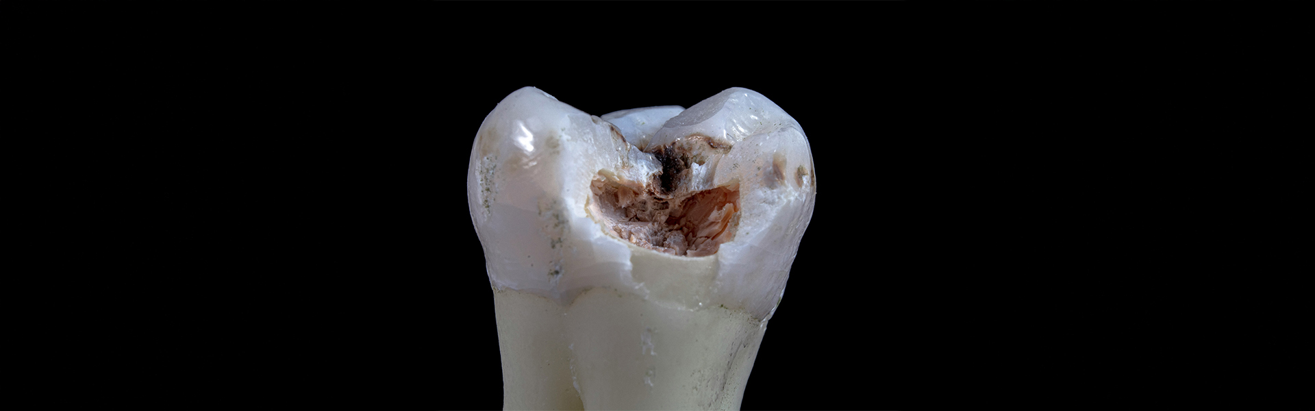 Chipped or Broken Tooth? Here’s What to Do Immediately